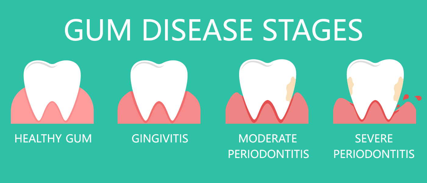 Klinik Pergigian I-Ria Kapar Healthy Gums Unhealthy Gums If, 56% OFF Klinik Pergigian I-Ria Kapar Healthy Gums Unhealthy Gums If, 56% OFF